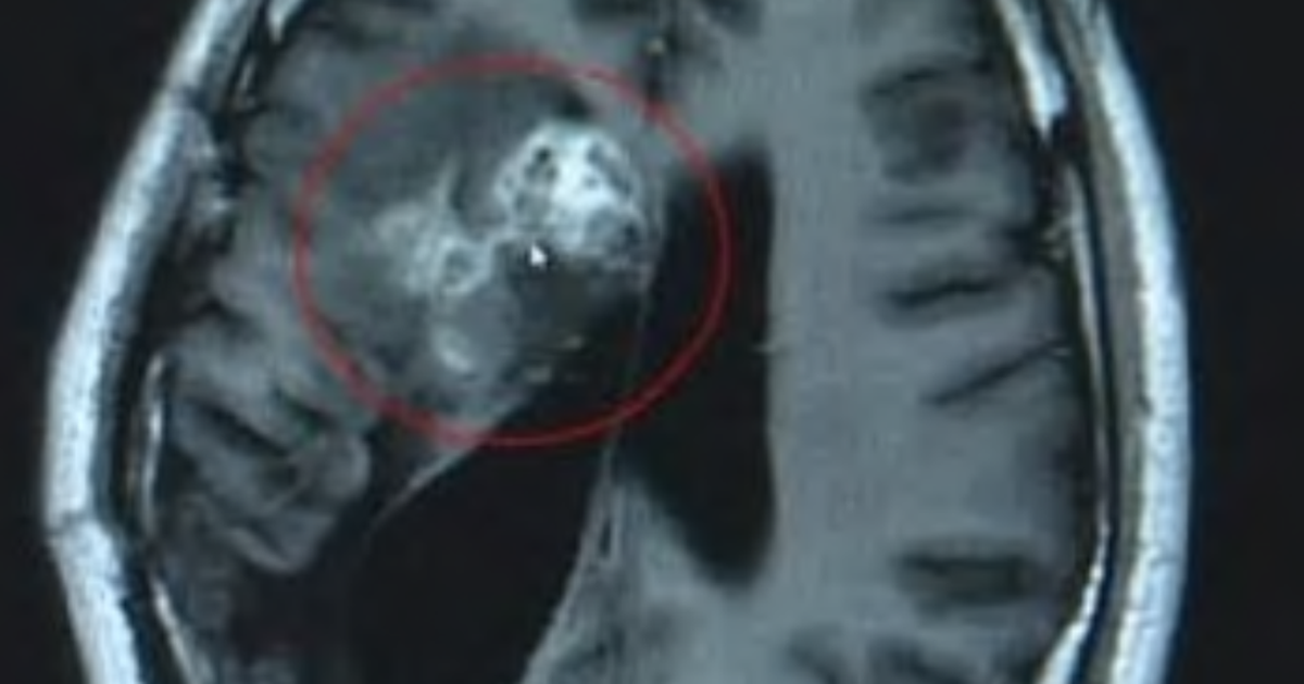 Paeluss õgis mehe aju 15 aastat